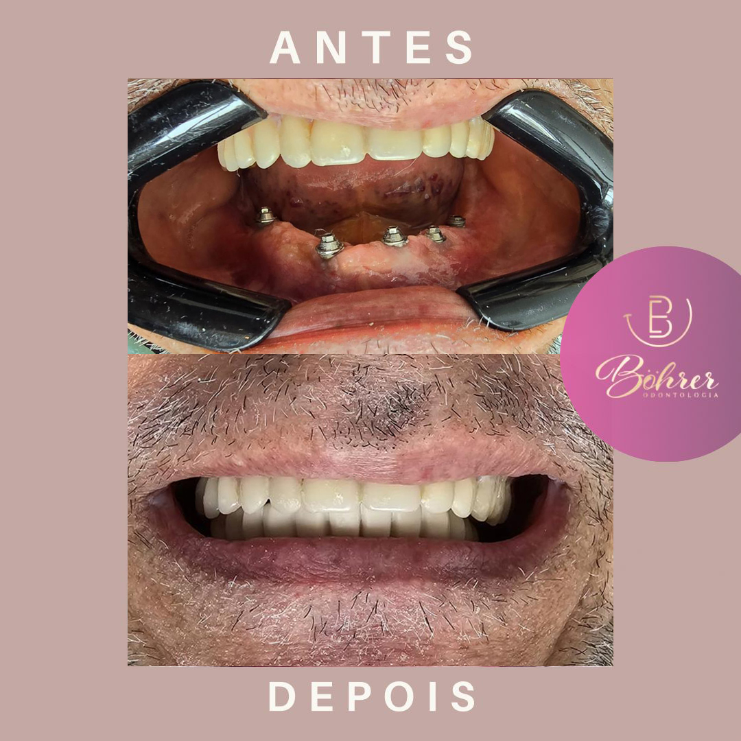 Prótese fixa – Bohrer Odontologia