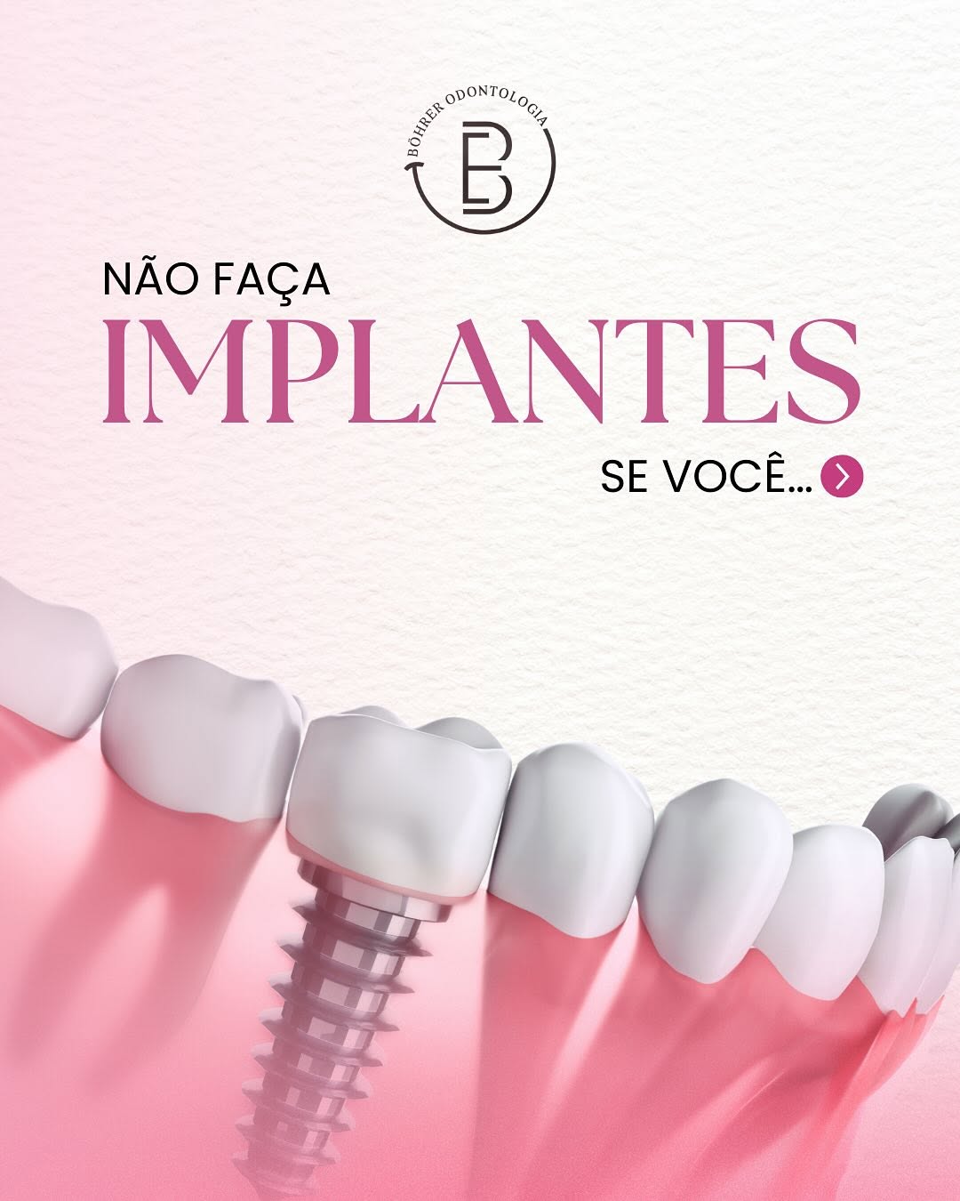 Implantes Dentários: Transforme Seu Sorriso e Sua Vida – Bohrer Odontologia